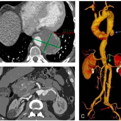 A Y B Axial Contrast Enhanced Imagea Large Periaortic Intramural