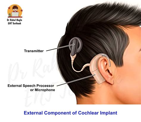 Cochlear Implant Surgery Procedure Benefits And Recovery Guide