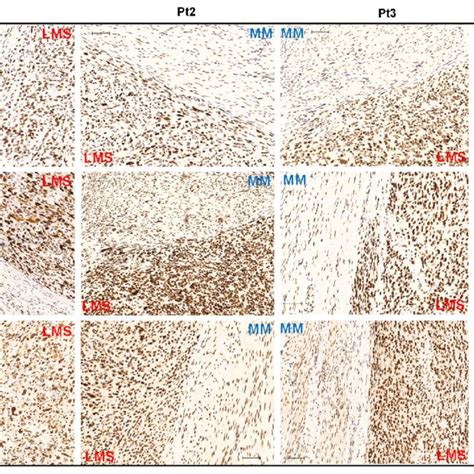 Ihc Staining Of Hdac1 2 And 3 In Human Ulms Tissues And Adjacent