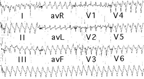 Right Bundle Branch Block Rate Related Primary Care Notebook