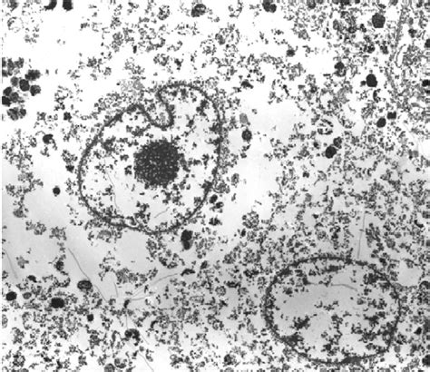 Electron Microscopy Of A Melanocytoma Cell With Indented Nucleus And
