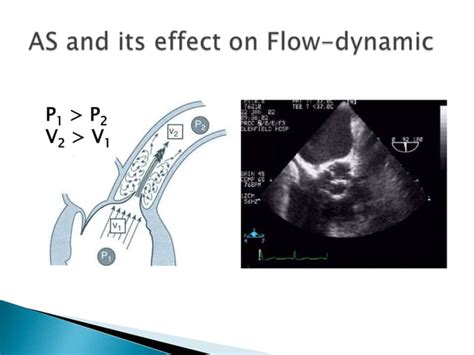 Aortic Valve Assessment Ppt