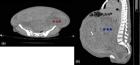 A Transverse Section Showing The Retroperitoneal Mass B