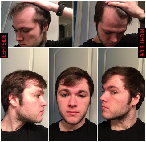 I Never Cared About My Hair Before I Started To Lose It Need Haircut