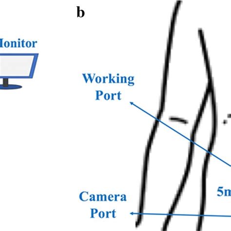 Pdf Purely Laparoscopic Feeding Jejunostomy A Procedure Which Deserves More Attention