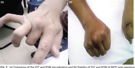 Figure 1 From Chronic Traumatic Sagittal Band Injury With Extensor