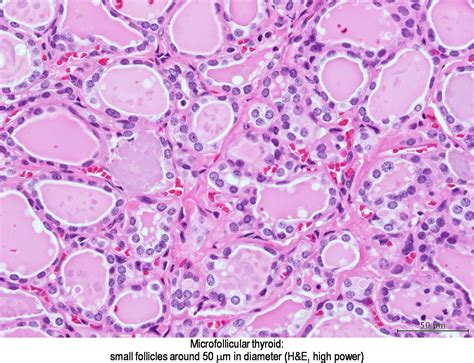 Hyperthyroidism Histology