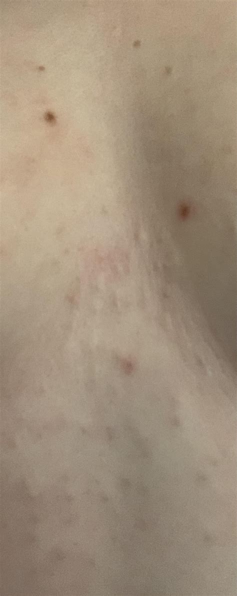 Eruptive Vellus Hair Cysts Rpopping
