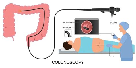 What Diseases Can Be Detected By A Colonoscopy Colowell America