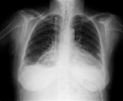 Radiografía De Tórax De La Paciente Incremento De Patrón Intersticial