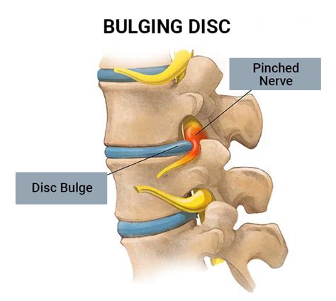 Cervical Slipped Discbulging Disc Doctors Nj And Nyc