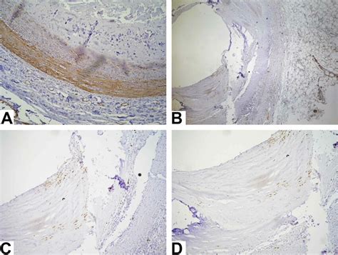 Atherosclerosis Of Coronary Arteries Fibroatheroma Stage And Smooth
