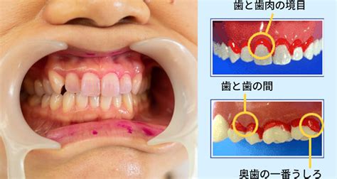 歯垢の染め出しと付着部位 歯科なんでも事典で調べよう い～でんたるへるす 日本アイ・ビー・エム健康保険組合