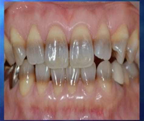 Tetracyclines Flashcards Quizlet