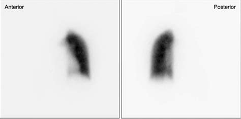 a perfusion scan shows perfusion defect in rt lung consistent with