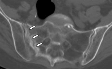 Sacral Insufficiency Fracture In A Patient With A Symptomatic Right