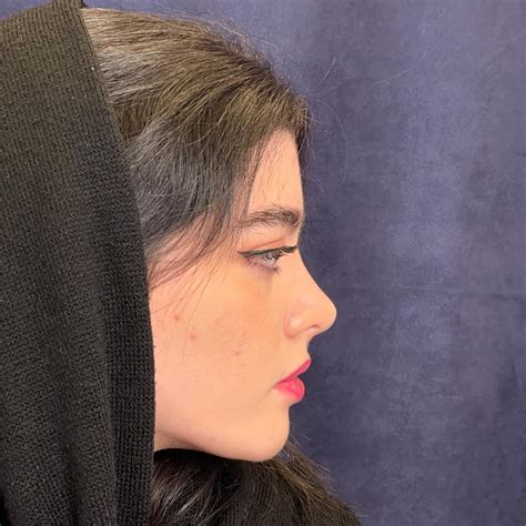 ‎دکتر سمیه طریقت‎ ‎نیوشا جون هشت ماه بعد از جراحی بینی گوشتی😍👌 لطفا ورق بزنید ☺️ از همه جهات