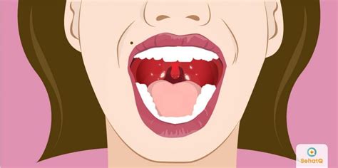Halaman Unduh Untuk File Contoh Radang Tenggorokan Yang Ke 53