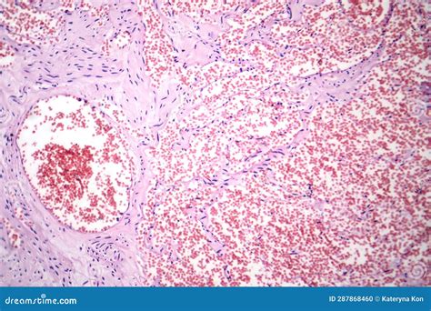 Capillary Hemangioma Light Micrograph Royalty Free Stock Image