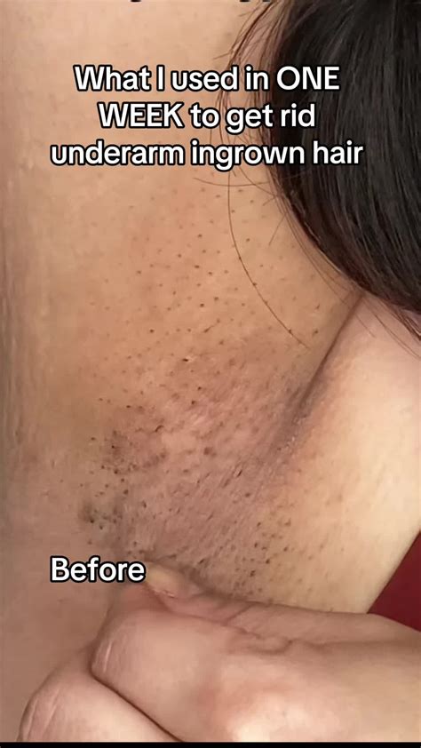 Ingrown Hair Armpit