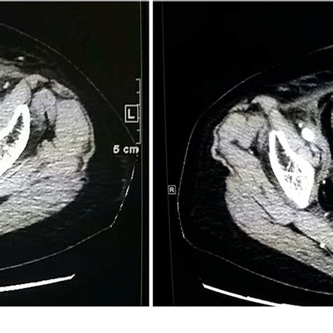 Pdf Risk Factors Microbiology And Management Of Infected Lymphocyst