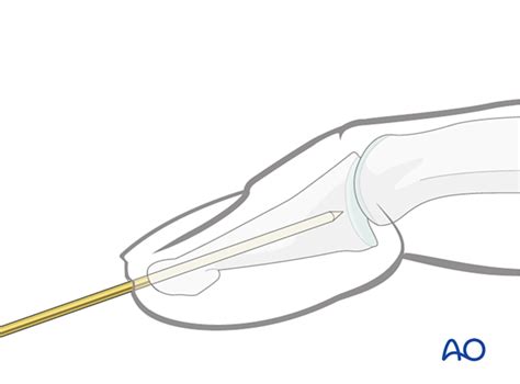Joint Transfixation With K Wire For Dislocation Of The Distal Interphalangeal Joint