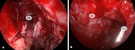 Endoscopic Views Via A Transsphenoidal Approach Of The Surgical Field