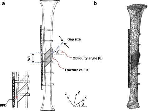 A Construction Of 3d Geometry Of Bone Fracture Model Consisting Of Download Scientific