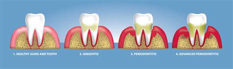 Gingivitis Symptoms Causes And Treatment Silverhill Dental Clinic