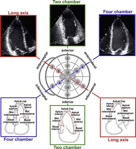 Fig 4 The 17 Segment Model Of The Left Ventricle Top Row Shows Actual