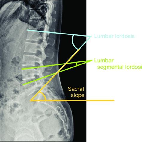 Measurement Techniques For Assessment Of Lumbar Lordosis Lumbar
