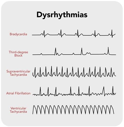 5 Common Dysrhythmias And Treatments Acls Certification Association