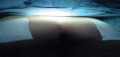 Pilonidal Sinus Minimal Excision And Primary Closure Under The