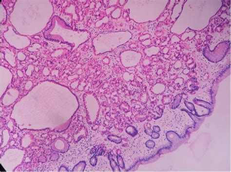 Fundic Gland Polyp Histopathologyguru