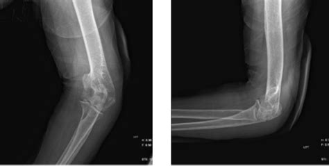 Elbow Bursectomy Right Olecranon Complete Orthopedics