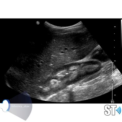 Renal Pathology Artofit