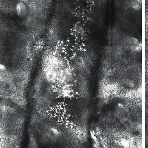Clinical Appearance Of Tinea Nigra Highlighted By The Circle Download Scientific Diagram