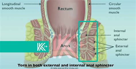 Faecal Incontinence K3 مركز علاج البواسير بالليزر والدوبلر بدون