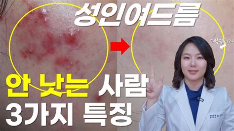 성인여드름이 안 낫는 3가지 이유 Youtube