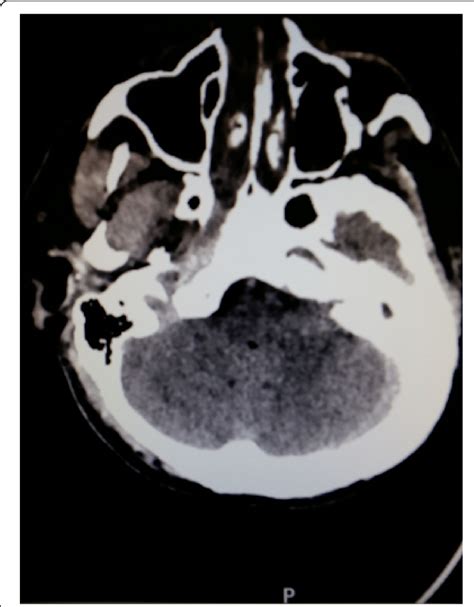 Skull Ct Horizontal Slice Of Brain With Left Side Mastoiditis Download Scientific Diagram