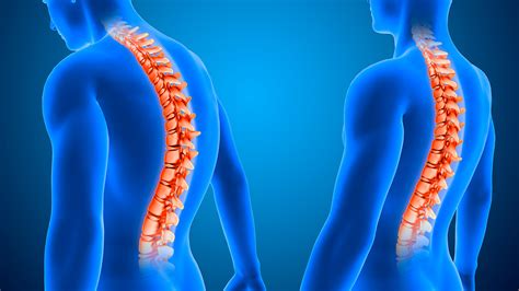 Artrodese Vertebral Avaliando os Benefícios e Riscos da Fusão da