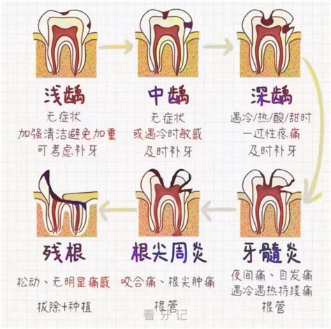 牙齿小黑洞蛀牙严重等级图片 看牙记网