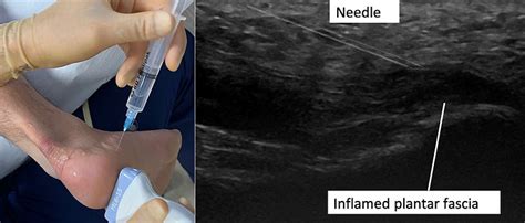 Effective Mortons Neuroma And Plantar Fascia Cortisone Injections
