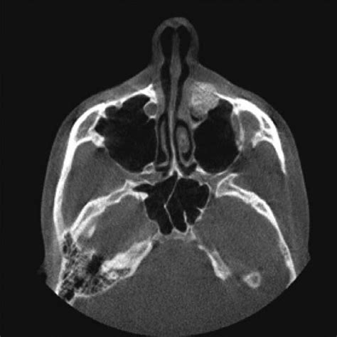Ct Scan Image Of The Paranasal Sinuses Without Contrast Showing A