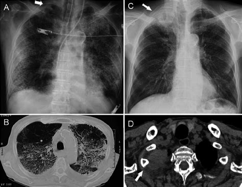 A X Ray Showing Bilateral Diffuse Reticular Shadows With A Nodular