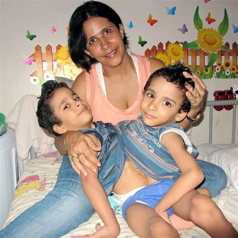 Conjoined Twins At The Pelvis