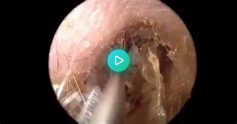 Clean Your Ears  On Imgur