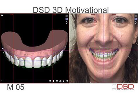 Digital Smile Design Smile Designers