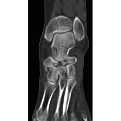 A By Ct Scan Radiologist Underlined The Dislocation Of The Navicular Download Scientific
