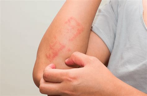 Cómo Prevenir Y Tratar Los Eccemas De La Piel Mi Herbolario Online